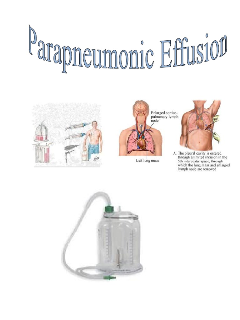 Parapneumonic Effusion - Case Study Adult I | PDF | Pneumonia | Lung