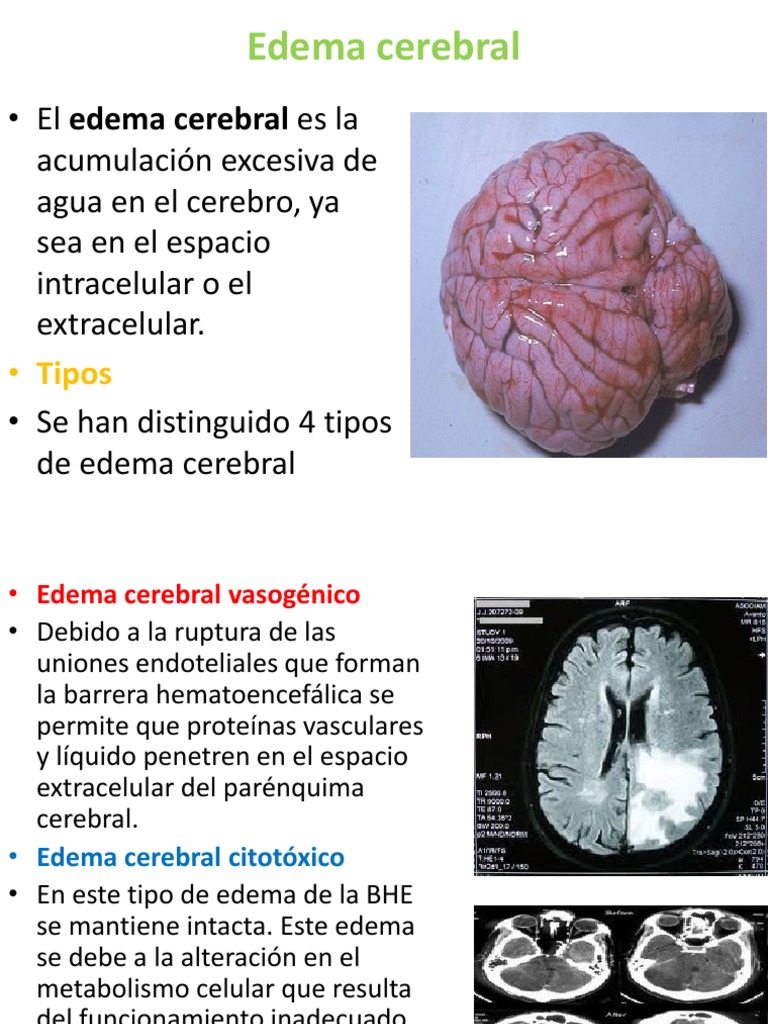 Edema Cerebral Diapositiva Especialidades Medicas Enfermedades Y Trastornos