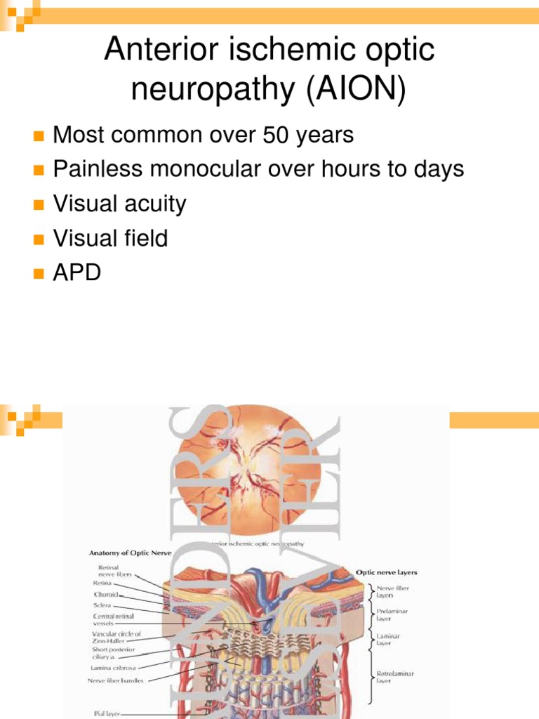 AION Anterior Ischemic Optic Neuropathy AION | PDF | Diseases And ...