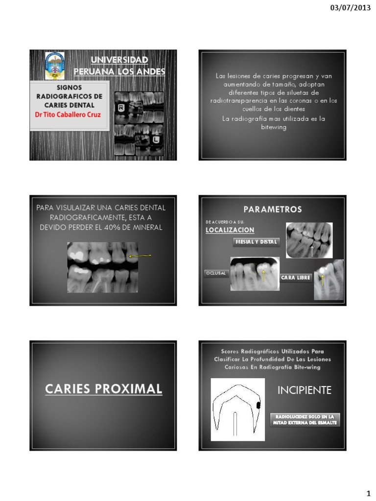 7 Interpretacion RX de Caries Dental | PDF | Esmalte de dientes ...