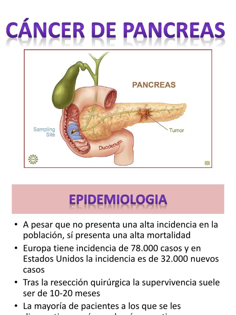 Cancer de Pancreas