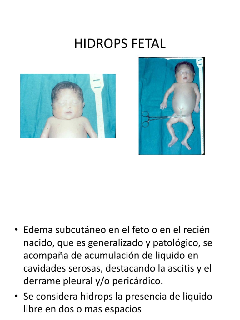 Hidrops Fetal | PDF | Bienestar | Ciencia y matemática