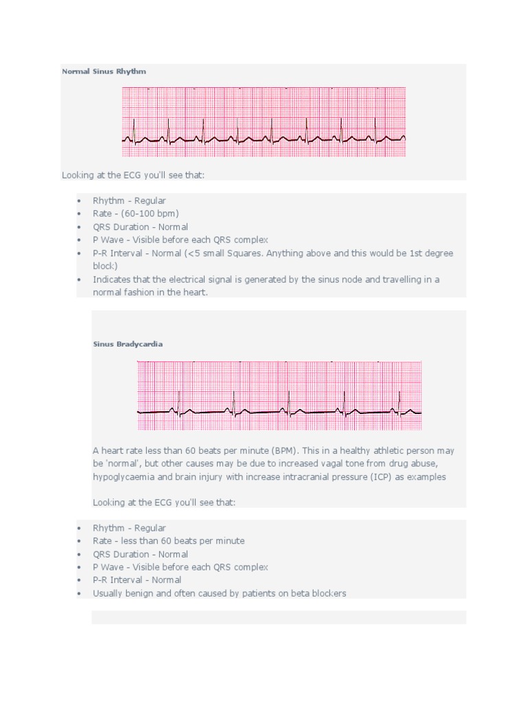 Normal Sinus Rhythm | PDF | Electrocardiography | Heart
