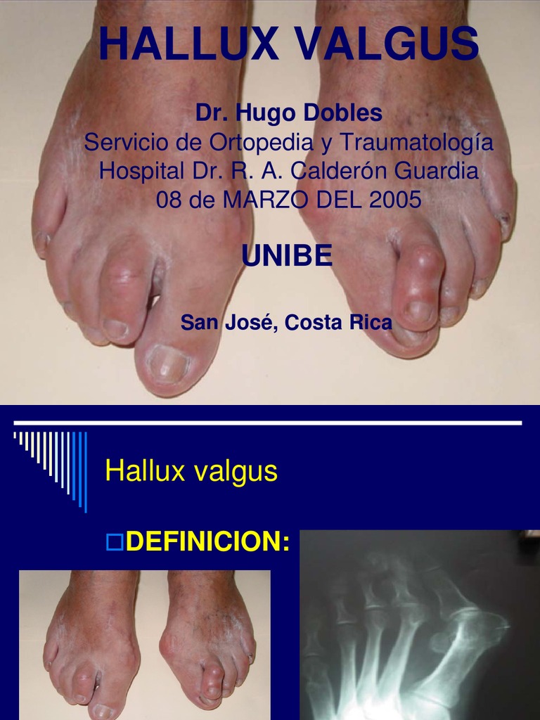 Tratamiento Y Anatomía Del Hallux Valgus Pdf Dedo Del Pie