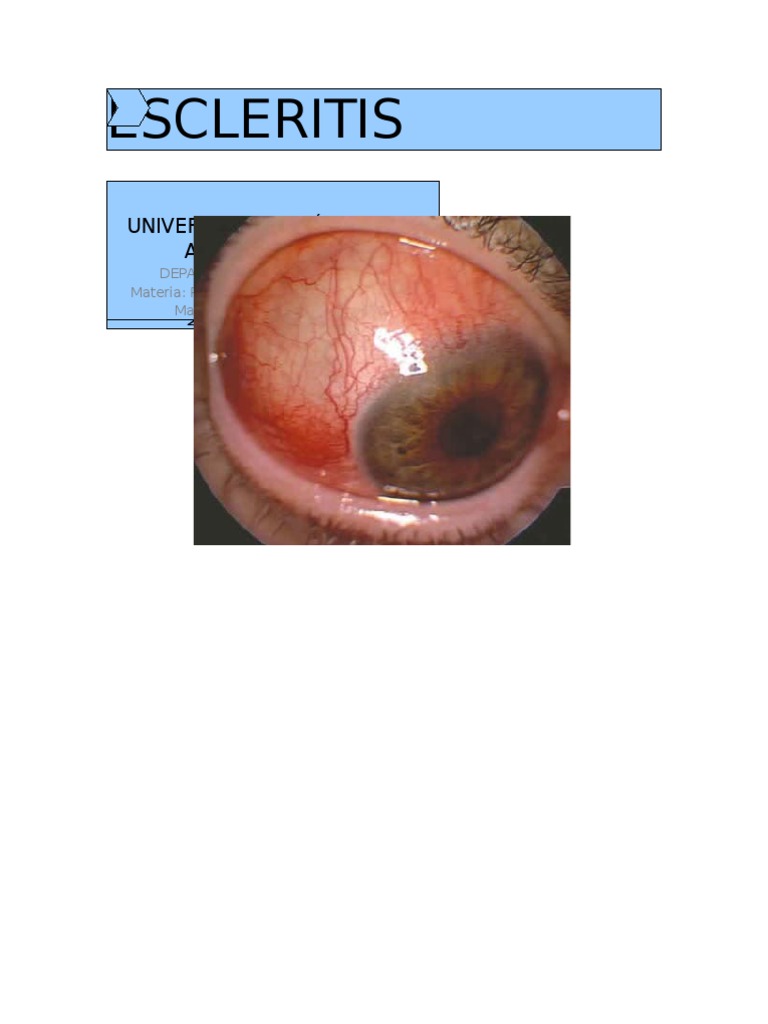 Escleritis Infecciosa y Anterior Nodular | PDF | Ojo humano | Droga ...