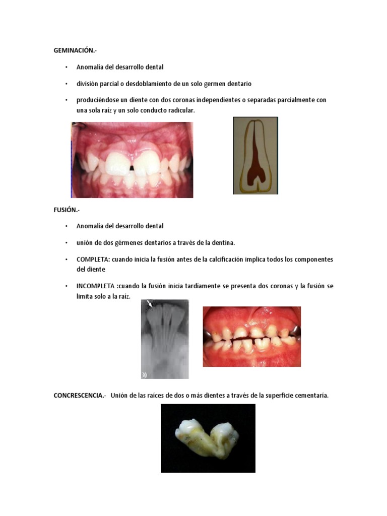 GEMINACIÓN | PDF | Diente humano | Esmalte de dientes
