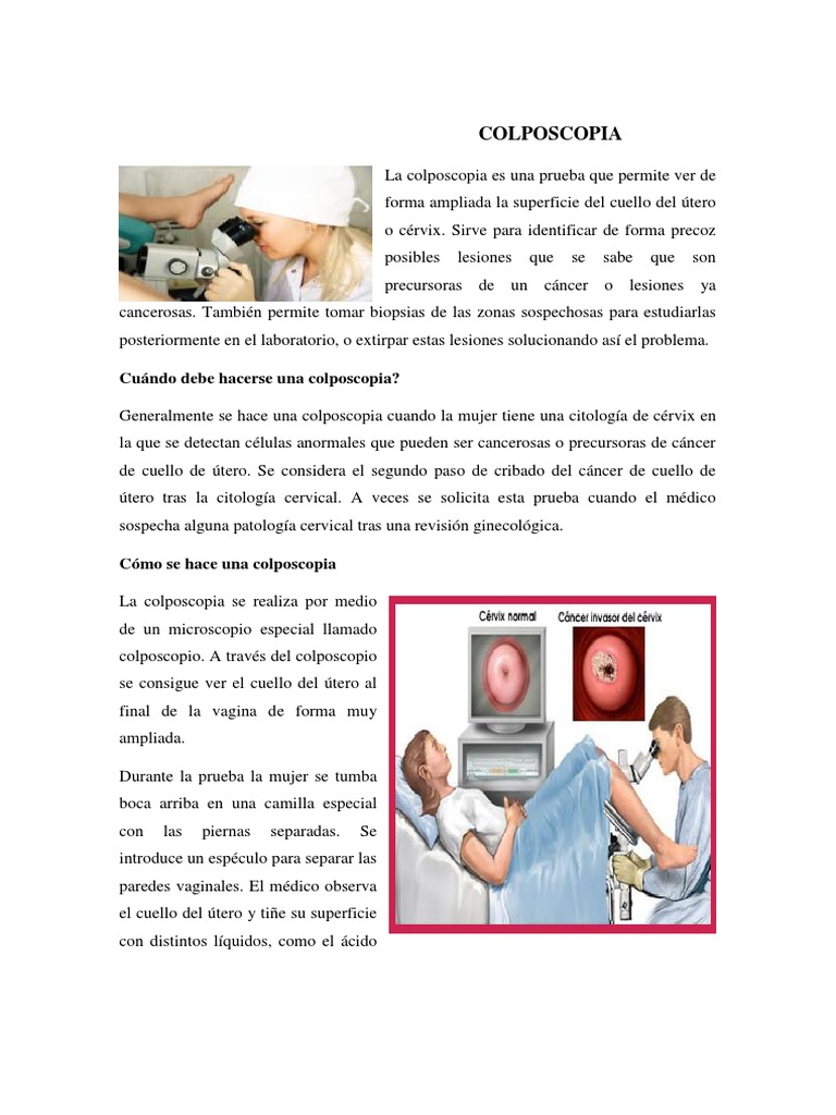 colposcopia | Cáncer de cuello uterino | Cáncer