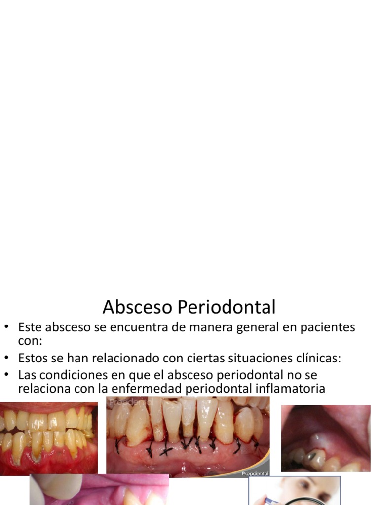 Absceso Periodontal | PDF | Inflamación | Dolor