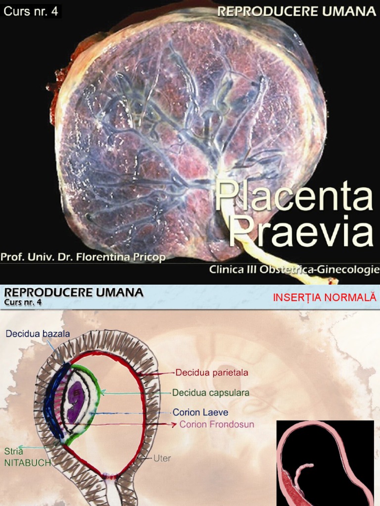 Placenta Praevia