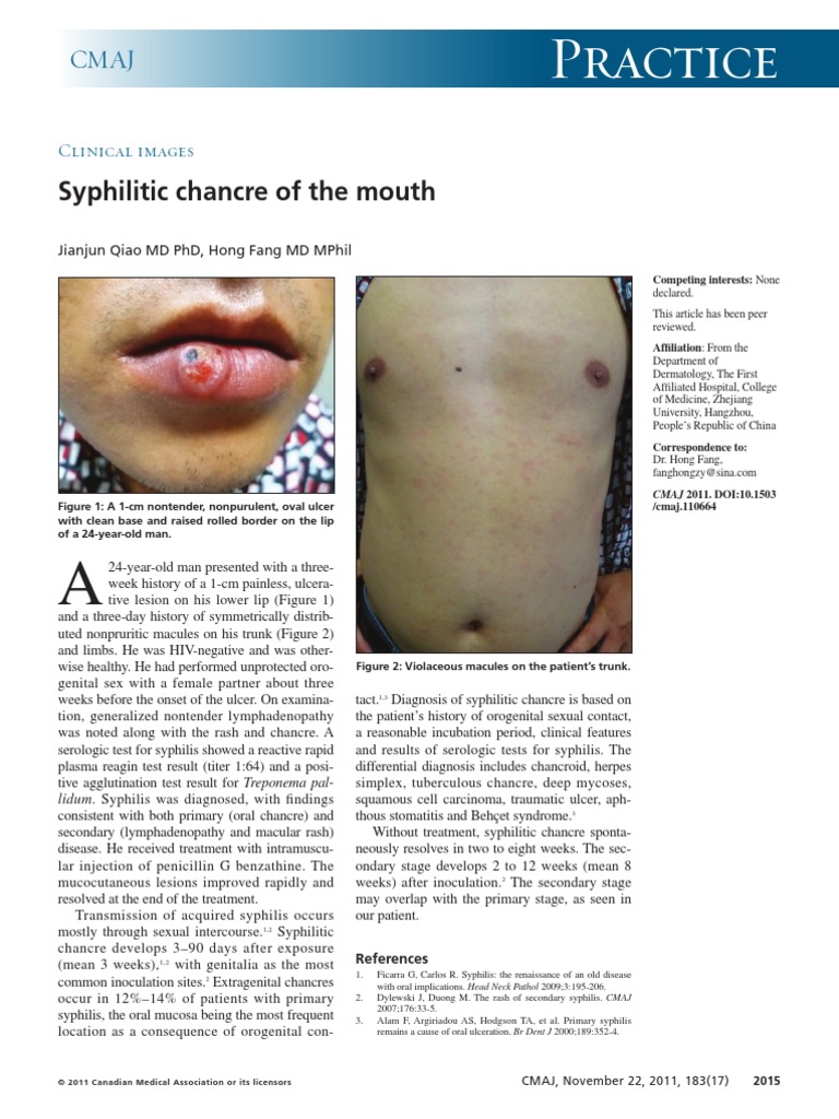 Practice: Syphilitic Chancre of The Mouth | Download Free PDF ...