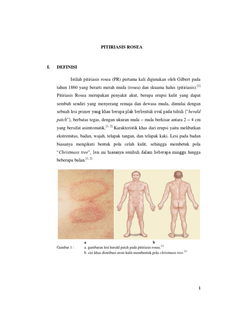 PITIRIASIS ROSEA PITIRIASIS ROSEA PITIRIASIS ROSEA PITIRIASIS ROSEA ...