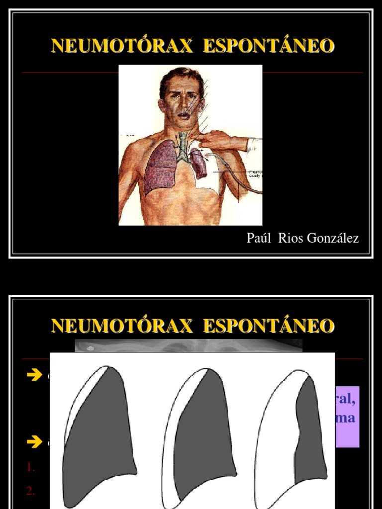 Neumotórax Espontáneo: Causas y Tratamiento | PDF | Neumología ...