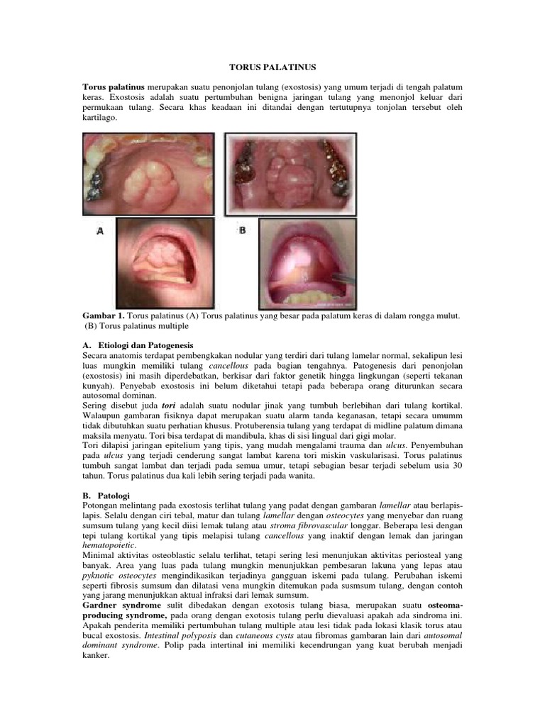 Torus Palatinus | PDF