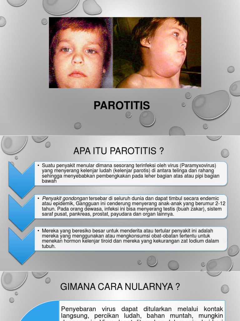 Parotitis | PDF
