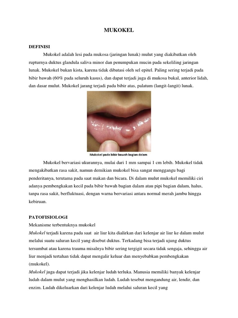Ciri dan Penanganan Mukokel Mulut | PDF