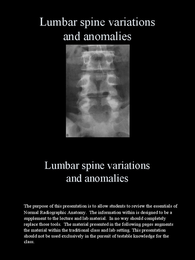 Lumbar Spine Variations and Anomalies Guide | PDF | Vertebra ...