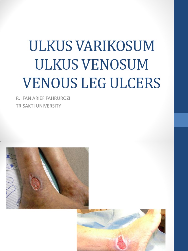 Ulkus Varikosum | PDF