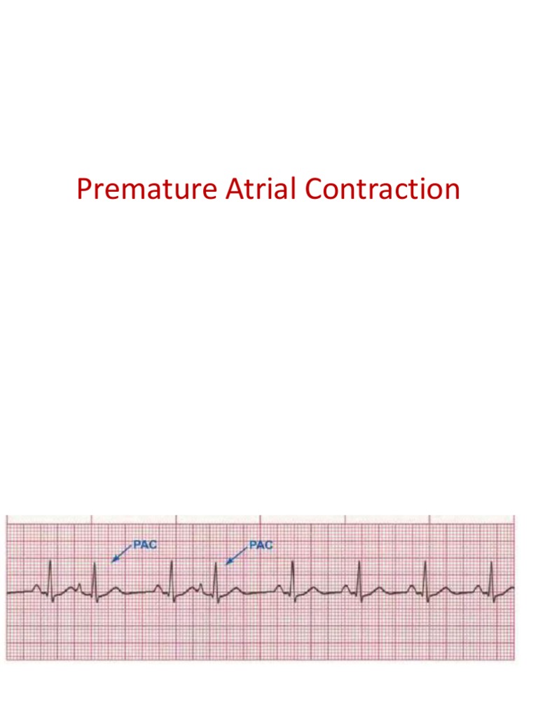 Understanding Premature Atrial Contractions | PDF