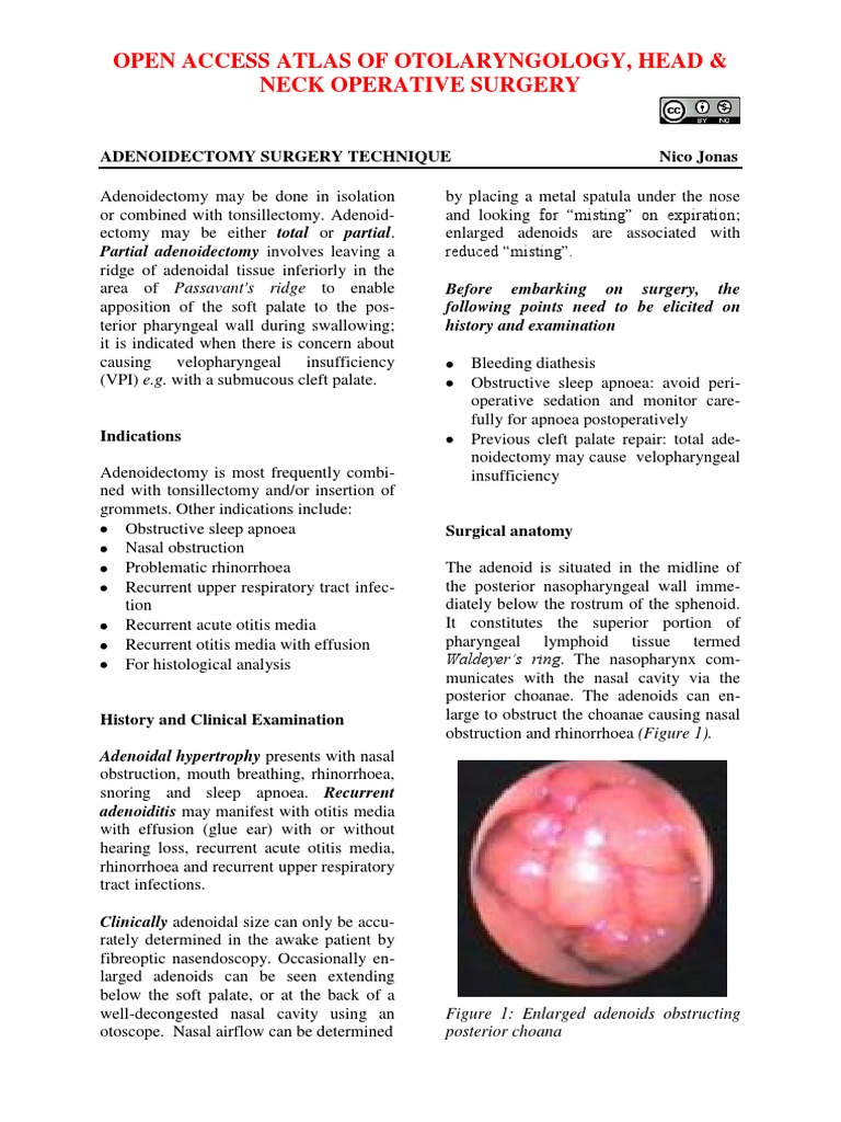 Paediatric Adenoidectomy PDF | PDF