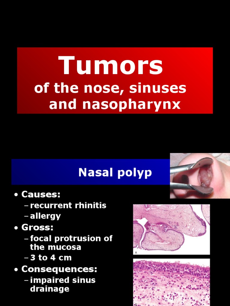 Tumors: of The Nose, Sinuses and Nasopharynx | PDF | Human Nose | Carcinoma