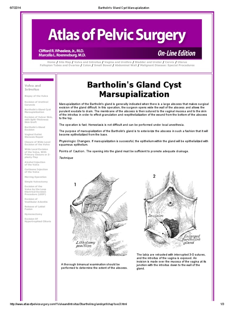 Bartholin's Gland Cyst Marsupialization | PDF | Vagina | Surgery