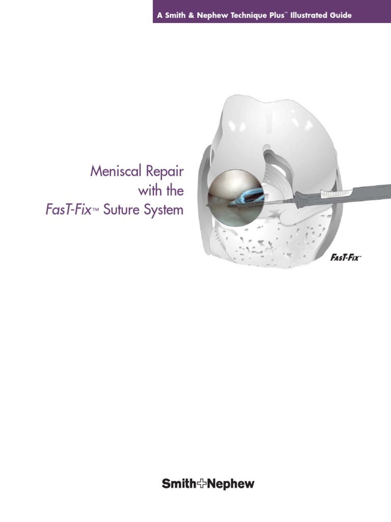 FastFix | Surgical Suture | Joints