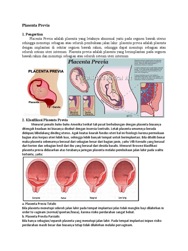 Plasenta Previa | PDF