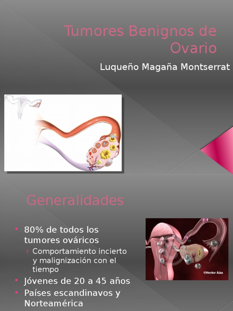 Tumores Benignos de Ovario | Cáncer | Neoplasias