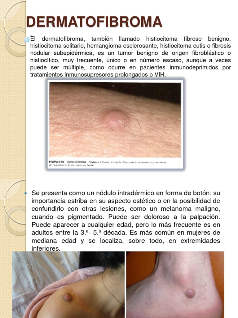 Derma To Fibroma | PDF | Sarcoma | Neoplasias