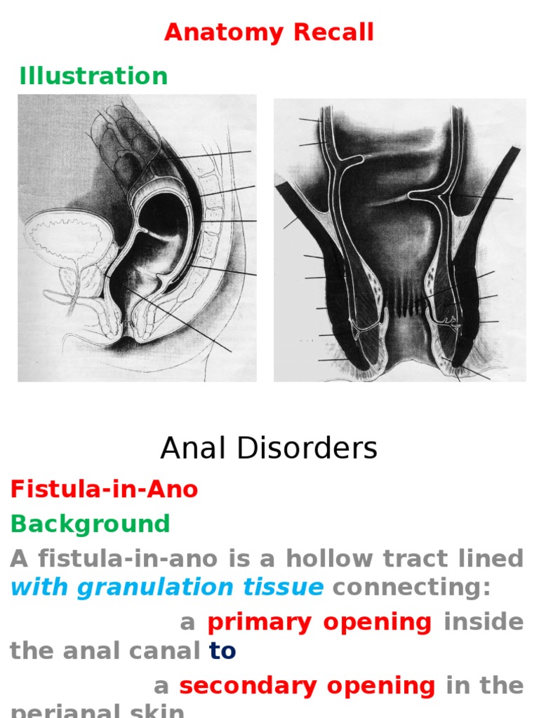 Anal Fistula2 | Download Free PDF | Gastroenterology | Medical Specialties