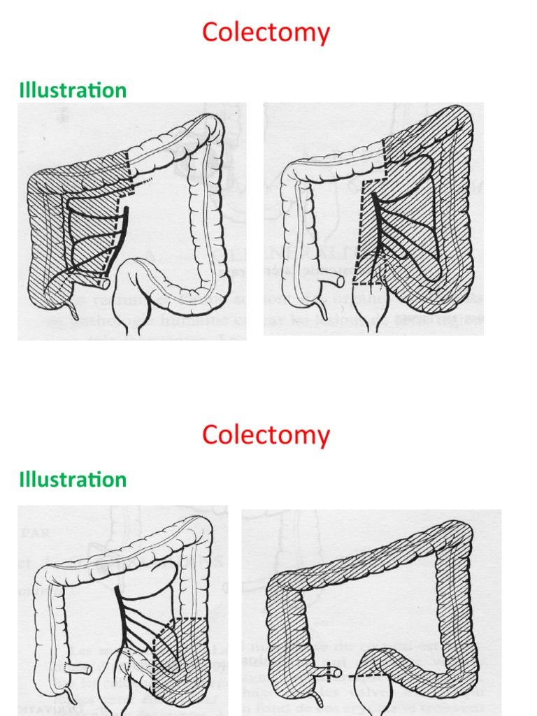 Colectomy Illustration | PDF | Art