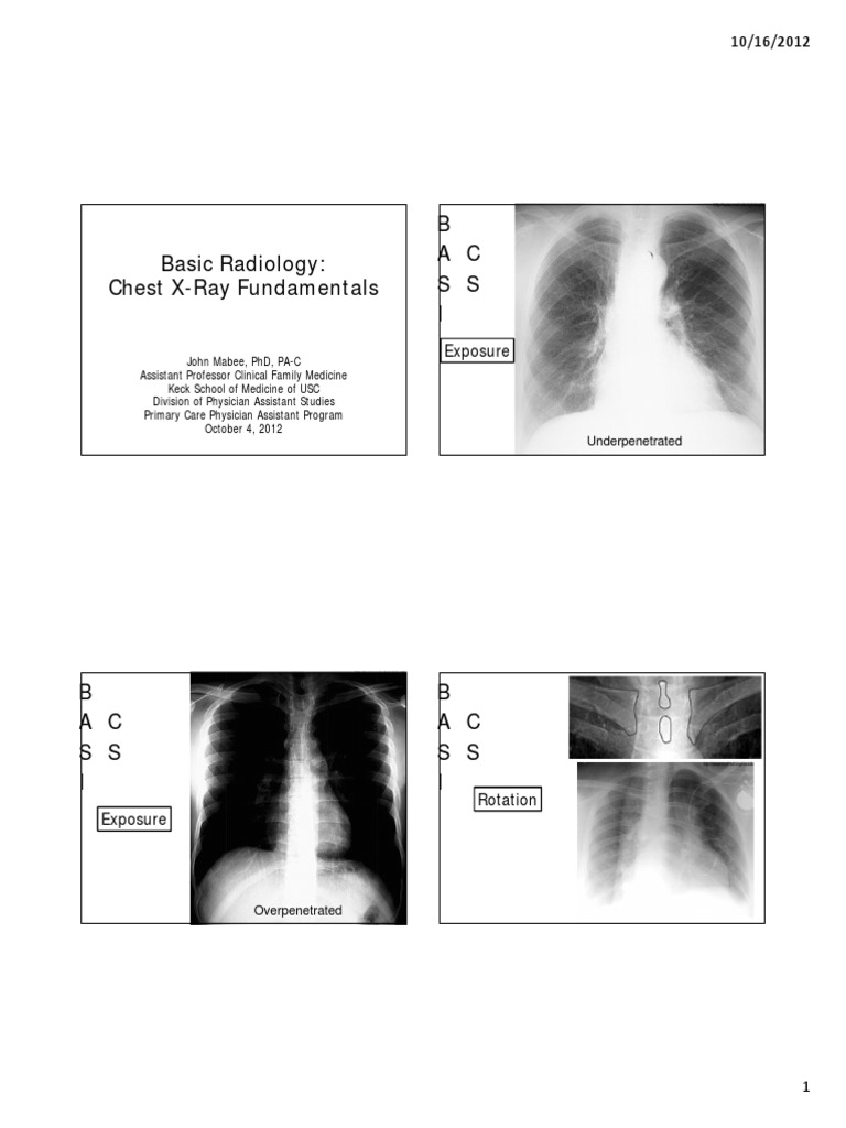 Basic Radiology | PDF | Pneumonia | Lung