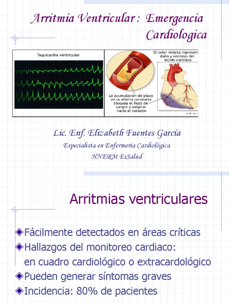 Arritmia Ventricular | Arritmia cardiaca | Enfermería