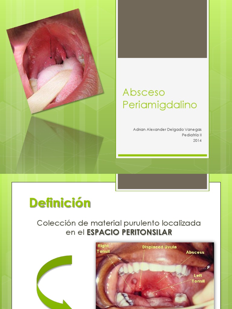 Absceso Periamigdalino