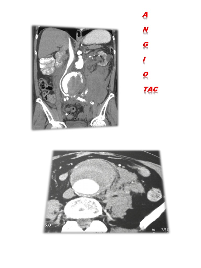 AngioTAC aórtico: descripción de la técnica, indicaciones y hallazgos ...