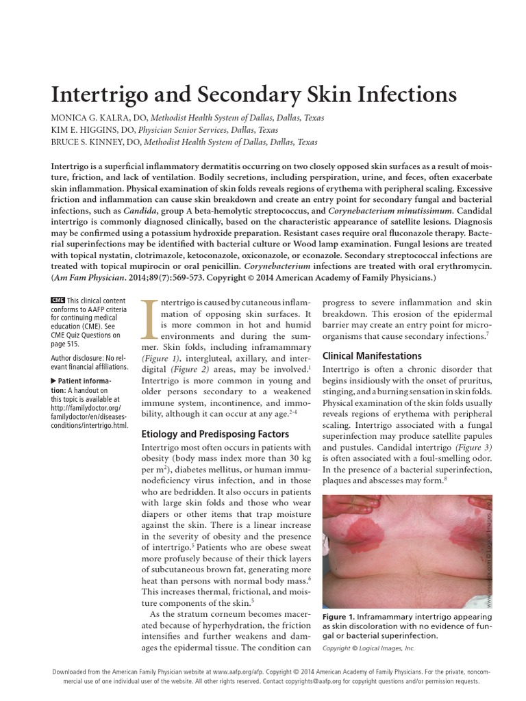 Intertrigo and Secondary Skin Infections | Candidiasis | Topical Medication