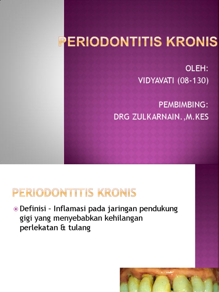 Periodontitis Kronis | PDF