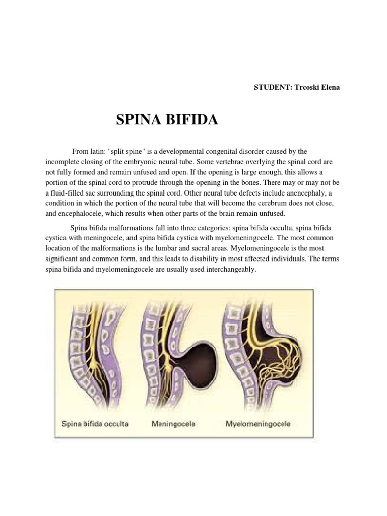Elena Trcoski (Spina Bifida) | Folic Acid | Vertebral Column