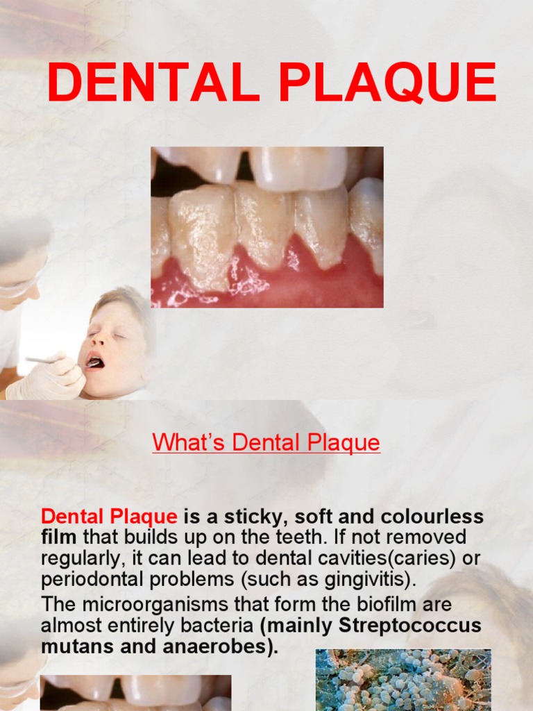 Understanding Dental Plaque Formation | PDF | Oral Hygiene | Dentistry