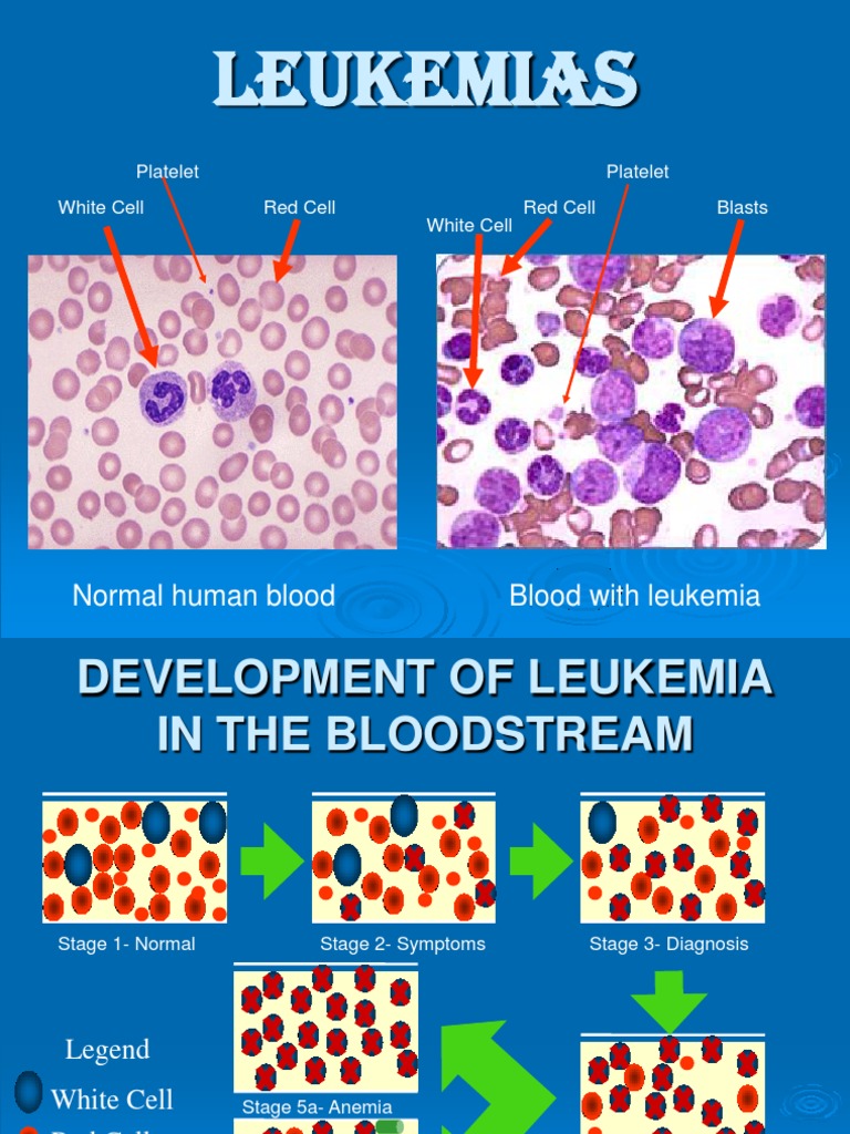 Leukemias | PDF | Leukemia | White Blood Cell