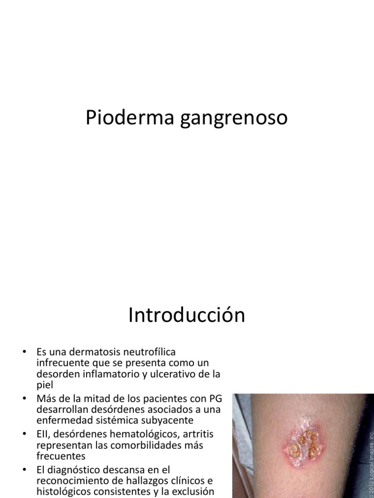 Pioderma Gangrenoso | PDF | Factor de necrosis tumoral alfa | Inflamación
