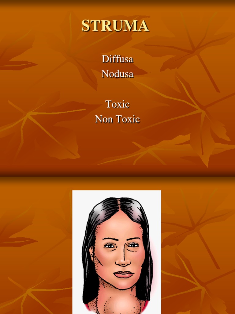 Struma: Diffusa Nodusa | PDF