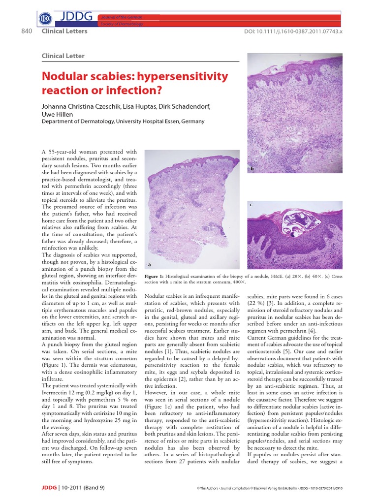 JDDG Nodular Scabies | Dermatology | Immunology