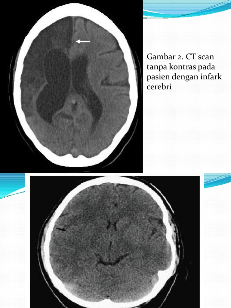 Gambaran CT Scan | PDF