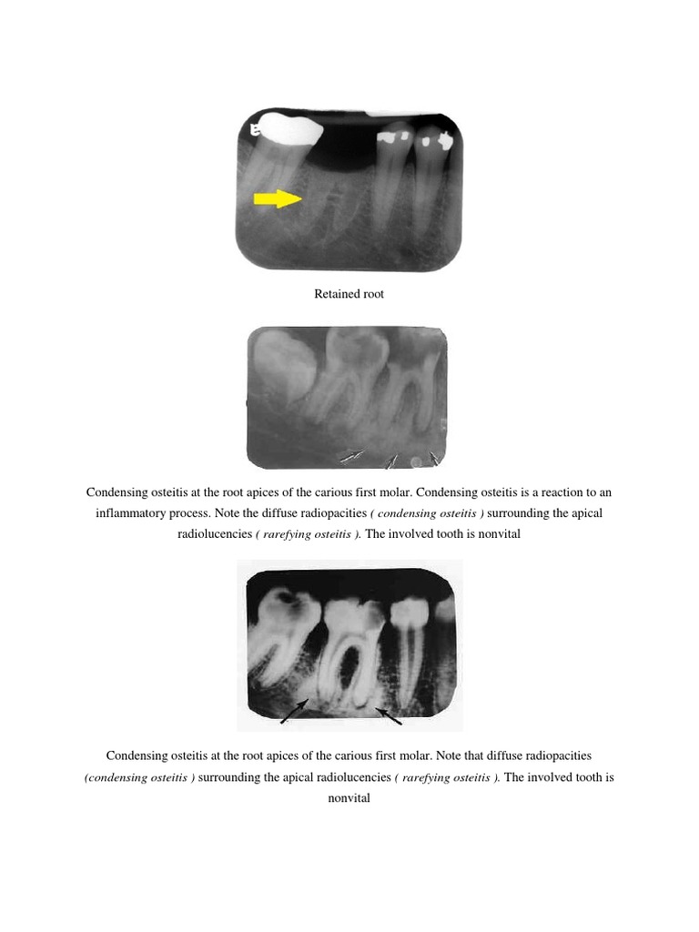 Retained Root + Condensing Osteitis | PDF
