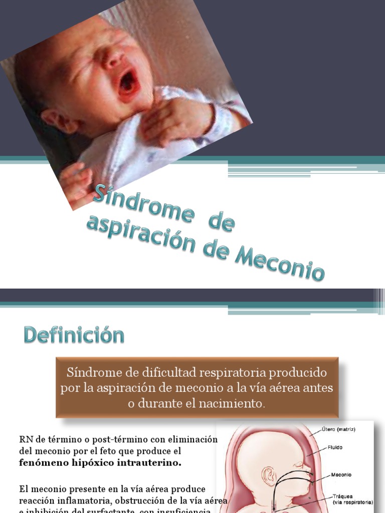 Síndrome de Aspiración de Meconio en RN | PDF | Neumonía | Microbiología
