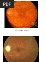 Marsupialization of Bartholin Cyst and Abscess - ACOG 2023 | PDF ...