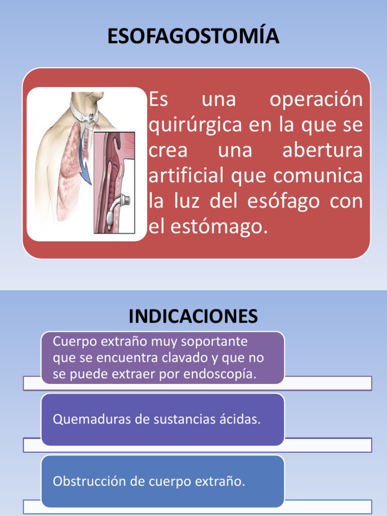 ESOFAGOSTOMÍA | PDF