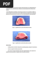 Existen 4 Tipos de Planos Terminales en La Dentición Primaria | PDF ...