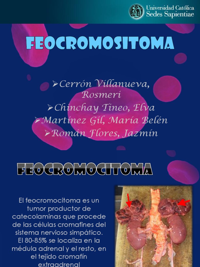 Feocromocitoma | PDF | Epinefrina | Glándula suprarrenal